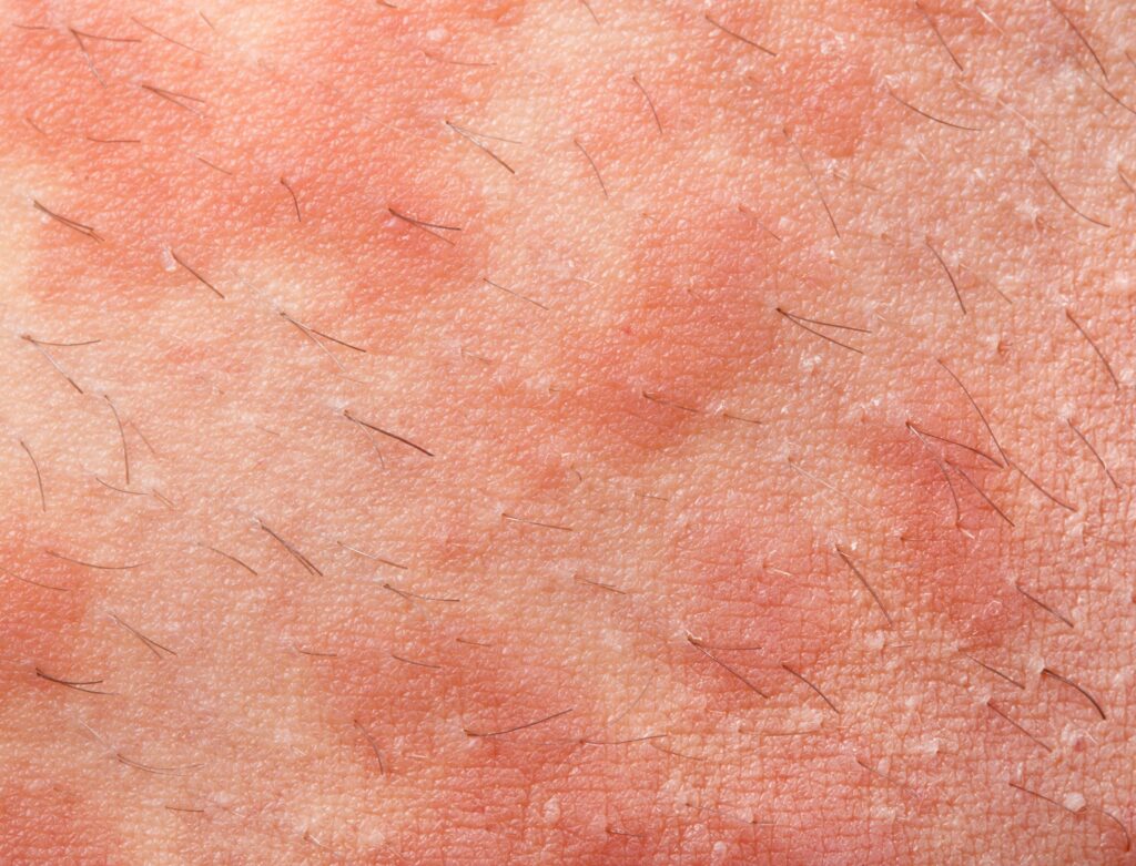 What Is Allergic Contact Dermatitis